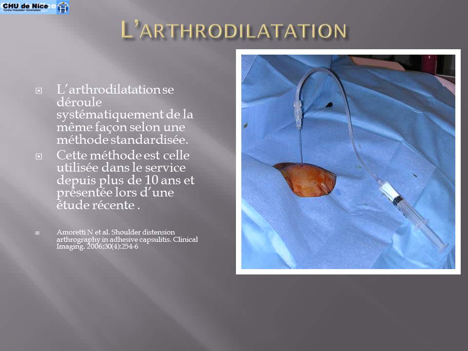 La capsulite rétractile de A à Z – INTERVENTIONAL RADIOLOGY