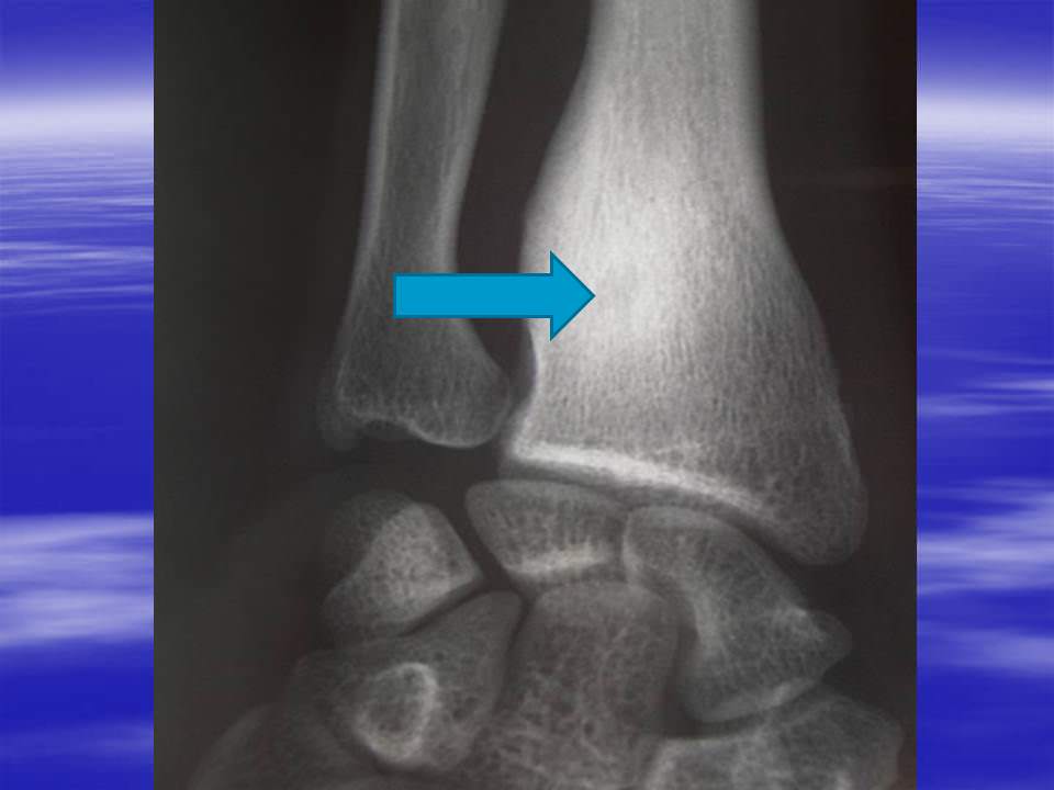 OSTEOME OSTOÏDE – INTERVENTIONAL RADIOLOGY
