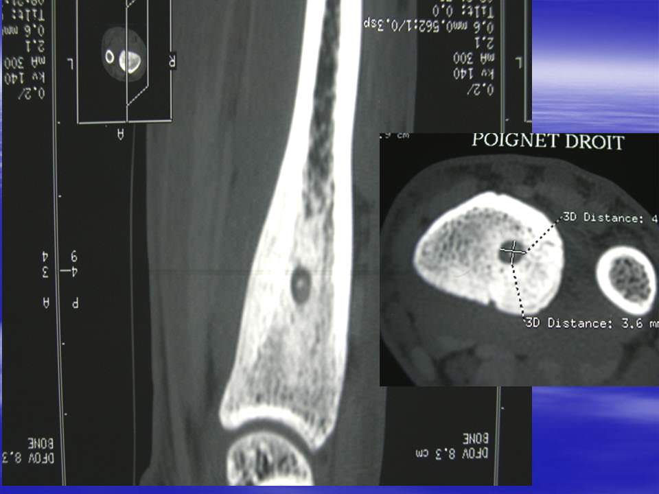 OSTEOME OSTOÏDE – INTERVENTIONAL RADIOLOGY