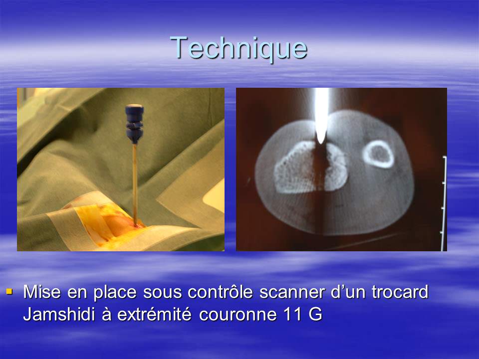 OSTEOME OSTOÏDE – INTERVENTIONAL RADIOLOGY