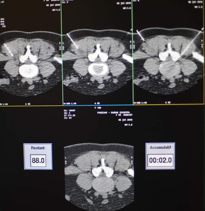 INFILTRATIONS – INTERVENTIONAL RADIOLOGY