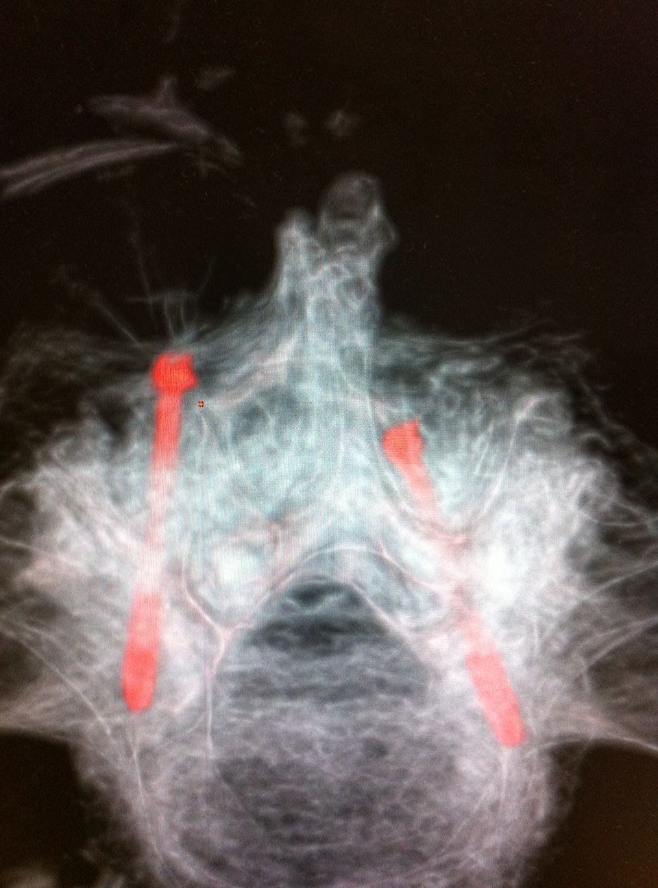 Lyse isthmique | INTERVENTIONAL RADIOLOGY