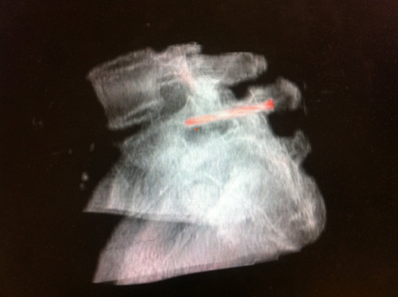 Lyse isthmique | INTERVENTIONAL RADIOLOGY