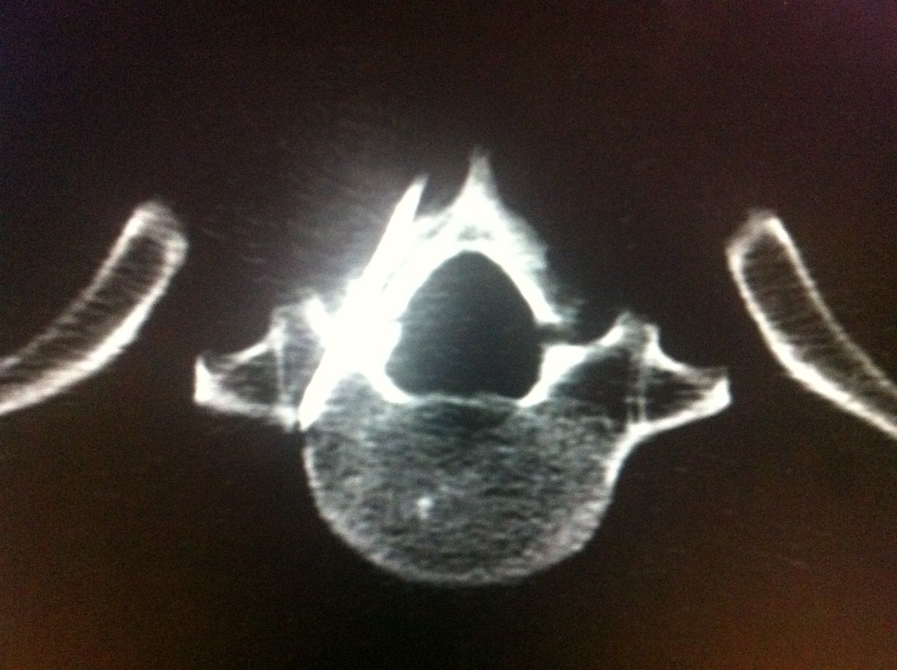 Lyse isthmique | INTERVENTIONAL RADIOLOGY