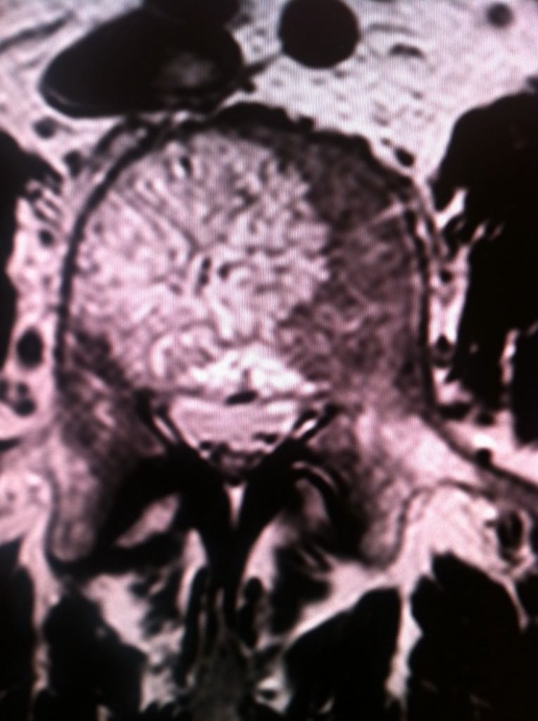Vertebroplastie et angiome - INTERVENTIONAL RADIOLOGY
